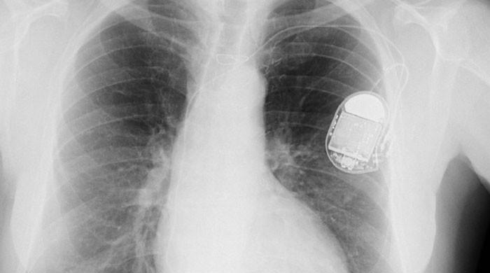 Scientists develop cardiac pacemaker powered by heartbeat
