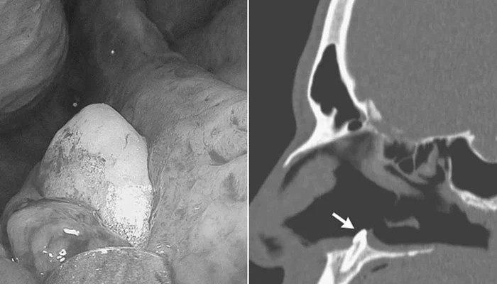 Doctors Discovered That Teeth Were Growing Inside The Human Nose GTN doctors-discovered-that-teeth-were-growing-inside-the-human-nose-gtn