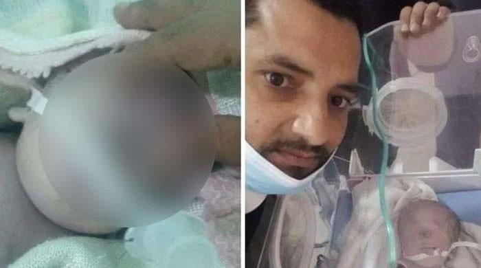 Woman gives birth to one-eyed baby in Yemen