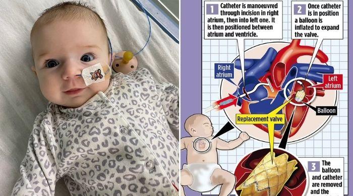 Ground-breaking surgery: Cow tissue and metal frame save baby's heart