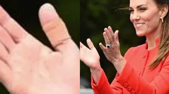 Kate Middleton's plastered thumb sparks speculations