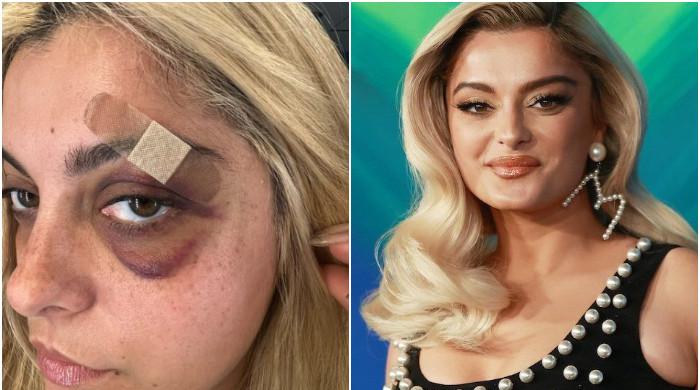 Bebe Rexha updates fans about eye injury in new tweet