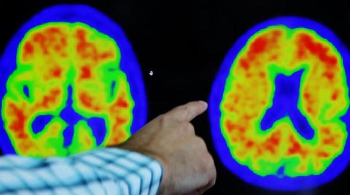Donanemab: Who will be able to afford miracle drug for Alzheimer's disease?